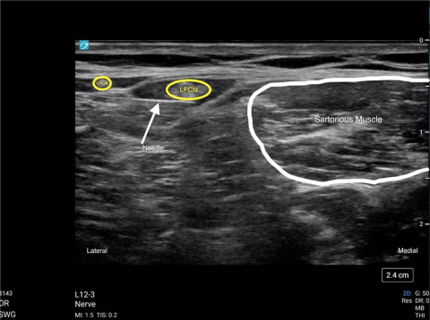 Lateral Femoral Cutaneous Nerve Block Procedure | FUJIFILM Sonosite